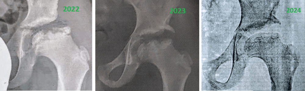 Osteotomía de Shelf - Enfermedad de Perthes - ASFAPE
